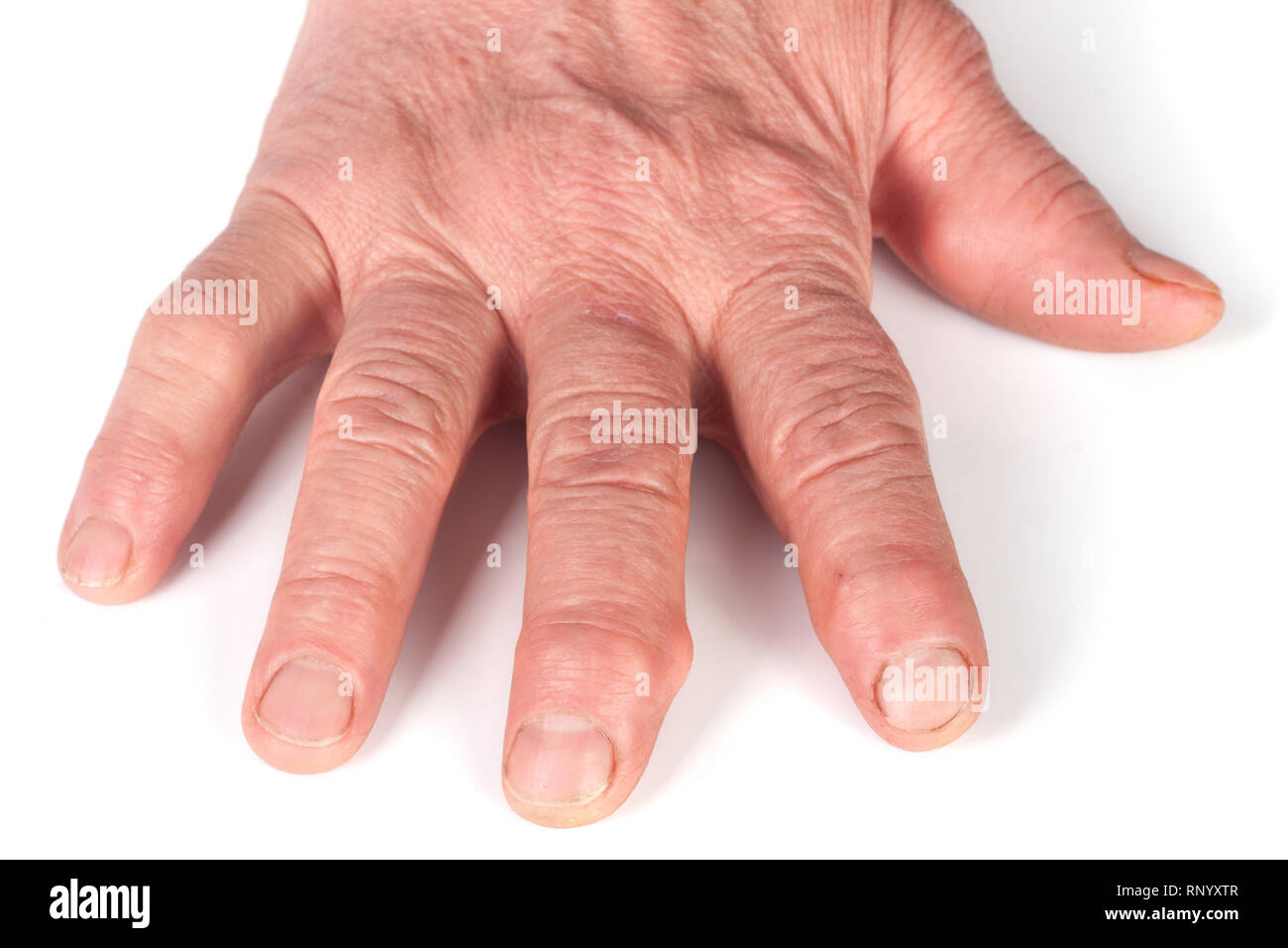 Rheumatoid polyarthritis of hands isolated on white background Stock ...