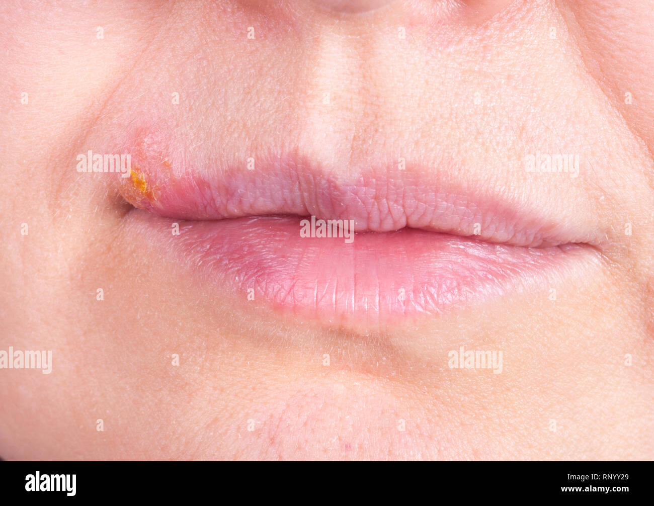 Scabs Stock Photos & Scabs Stock Images - Alamy