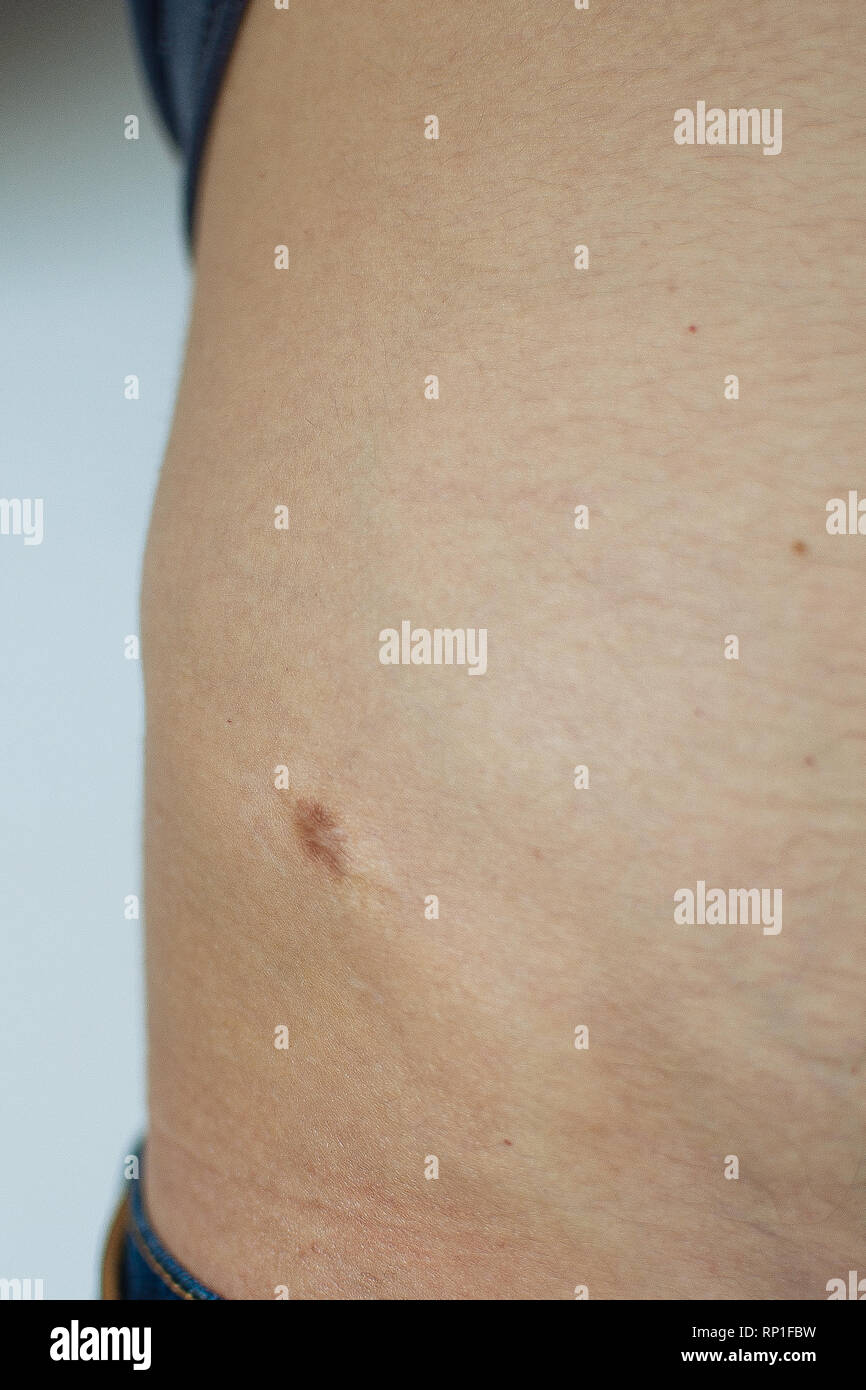 Female Belly Scar High Resolution Stock Photography and Images - Alamy