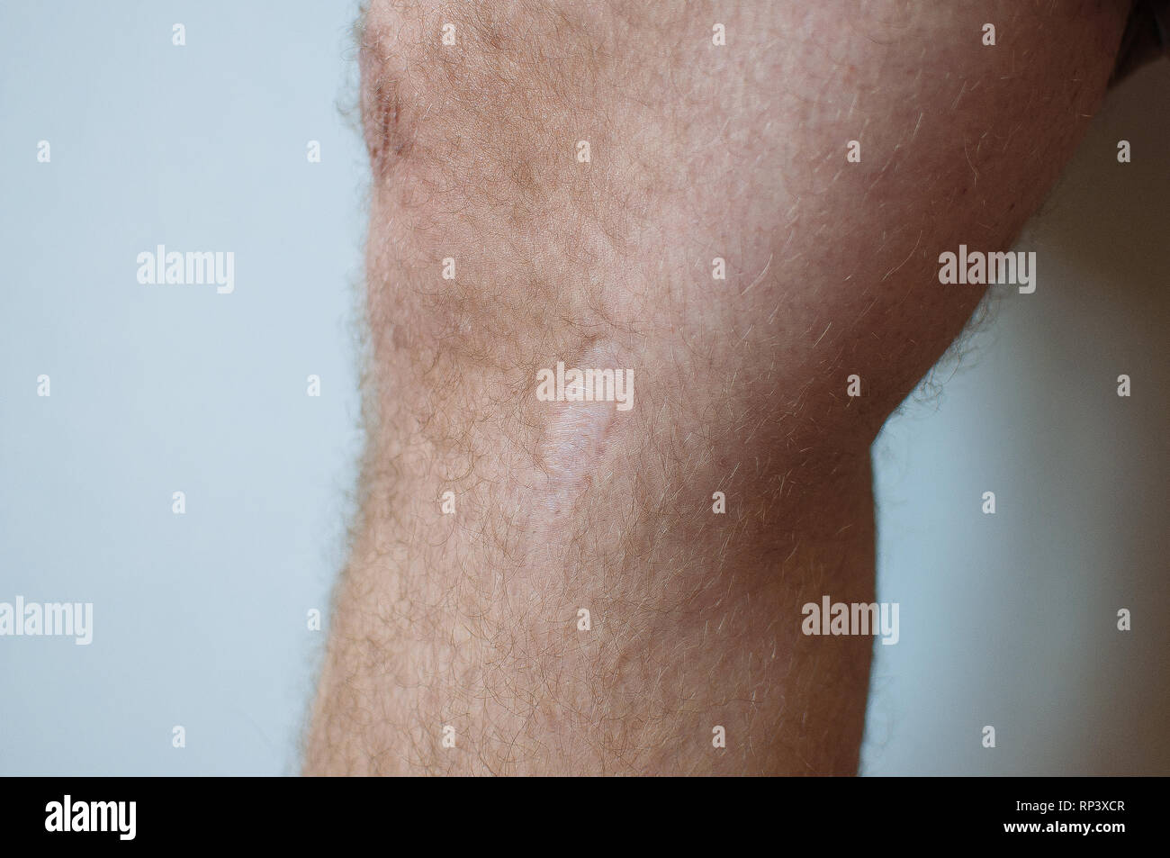 Scars on leg hi-res stock photography and images - Alamy