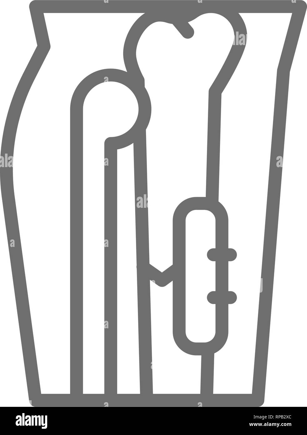 X-ray of broken leg, bone fixed with medical implantable plate line ...