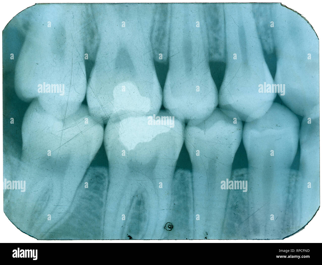 Old Dental x-ray with teeth in bad condition Stock Photo - Alamy