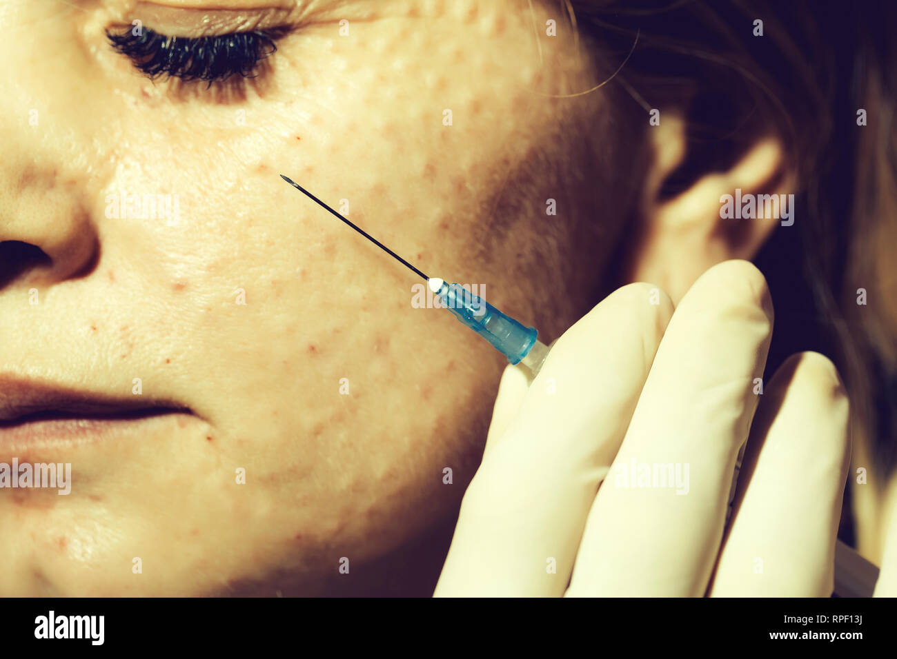 Female with pimples and syringe Stock Photo - Alamy