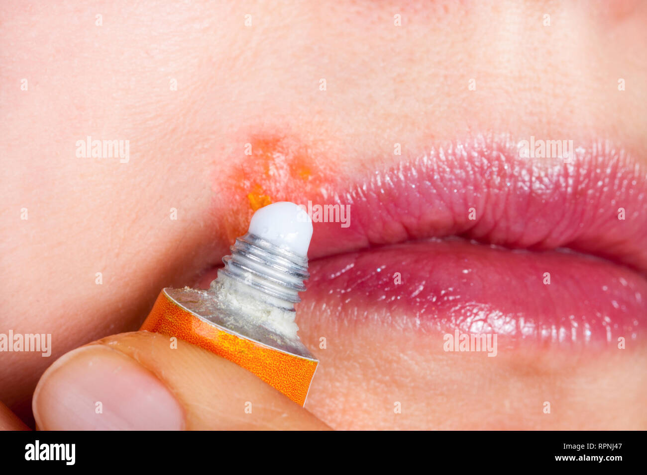 Herpes on the lip close-up macro. Woman lubricates the labial herpes ...