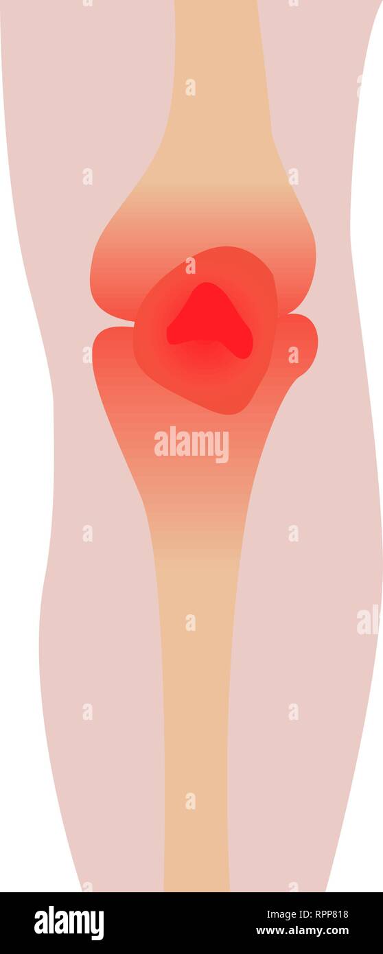 Knee injury inflamation redness vector illustration Stock Vector Image ...