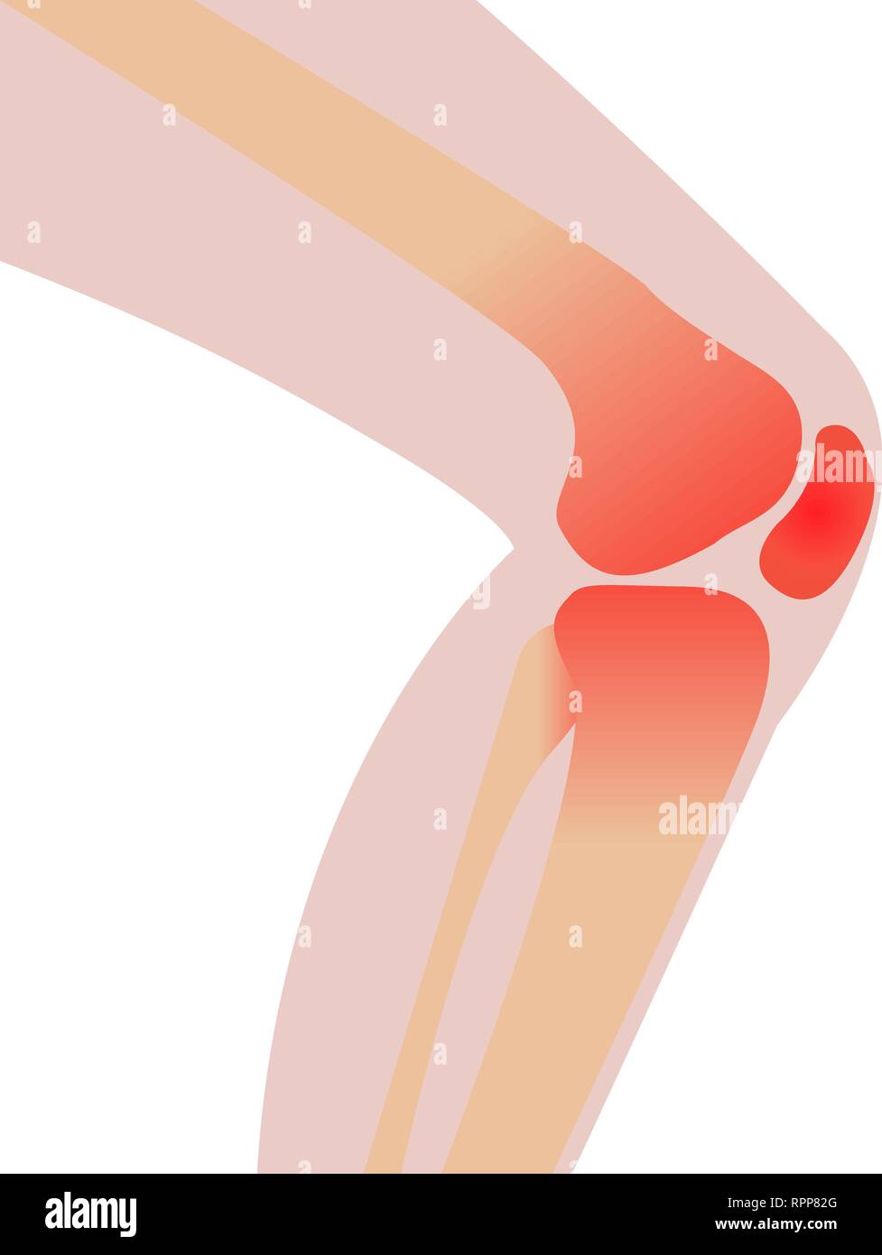 Knee pain because of injury vector illustration Stock Vector Image ...