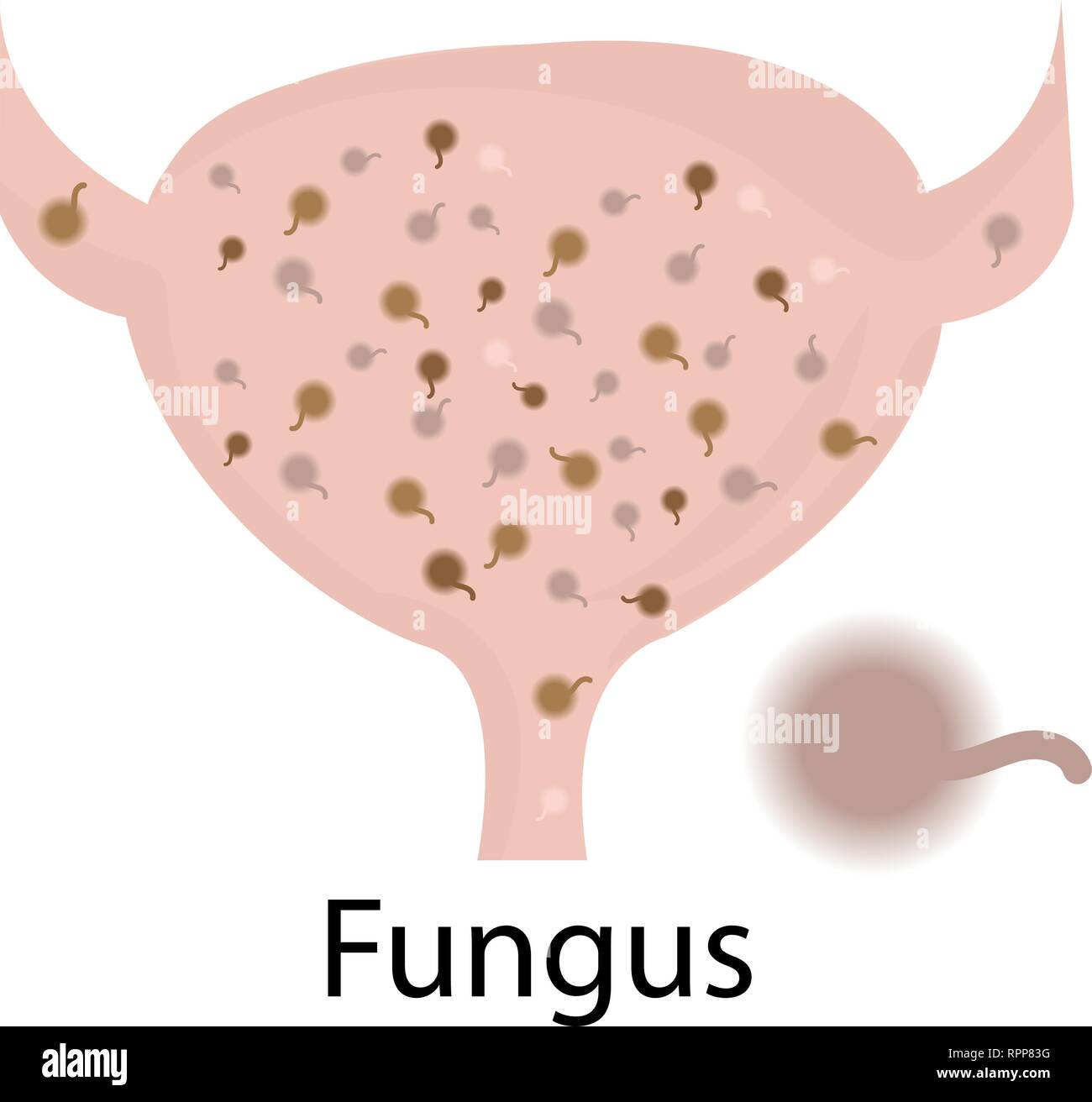 Bladder full of Fungus. Urinary tract infection. Vector illustration on ...