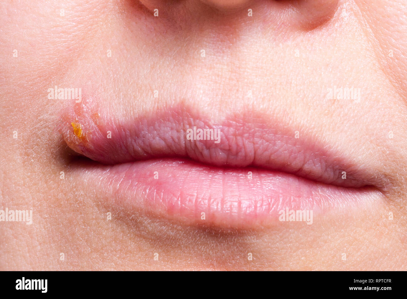 Herpes on lip hi-res stock photography and images - Alamy