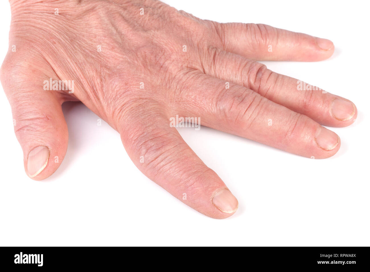 Rheumatoid polyarthritis of hands isolated on white background Stock ...