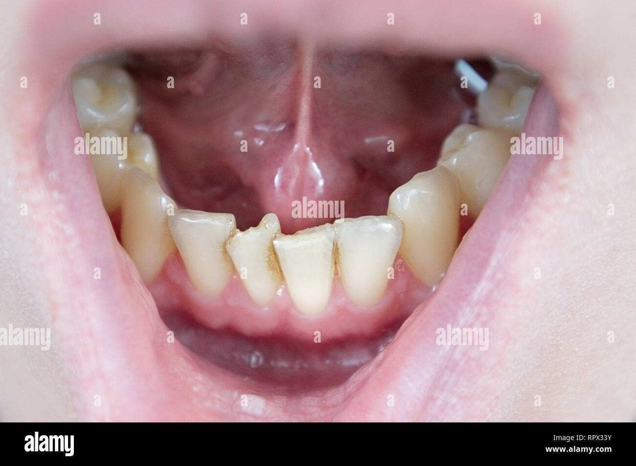 Crooked Teeth High Resolution Stock Photography and Images - Alamy