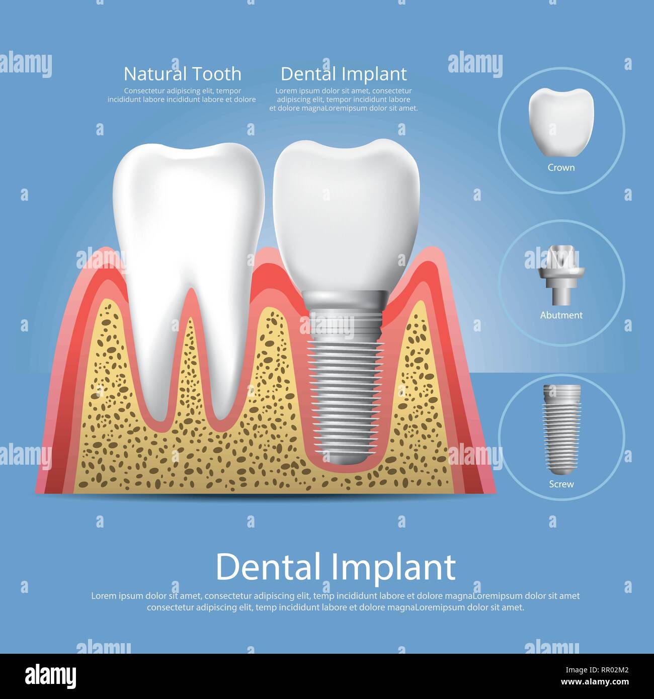 Human teeth and Dental implant Vector Illustration Stock Vector Image ...
