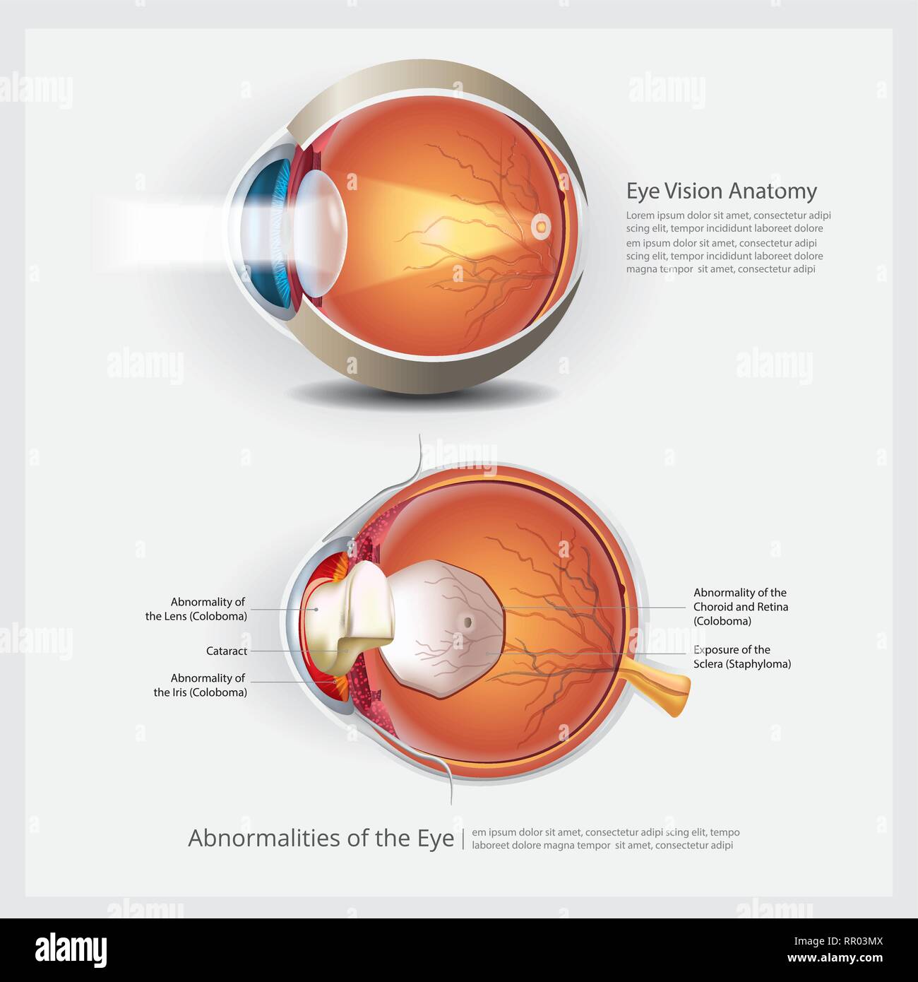 Eye Anatomy with Eye Abnormalities Vector Illustration Stock Vector ...
