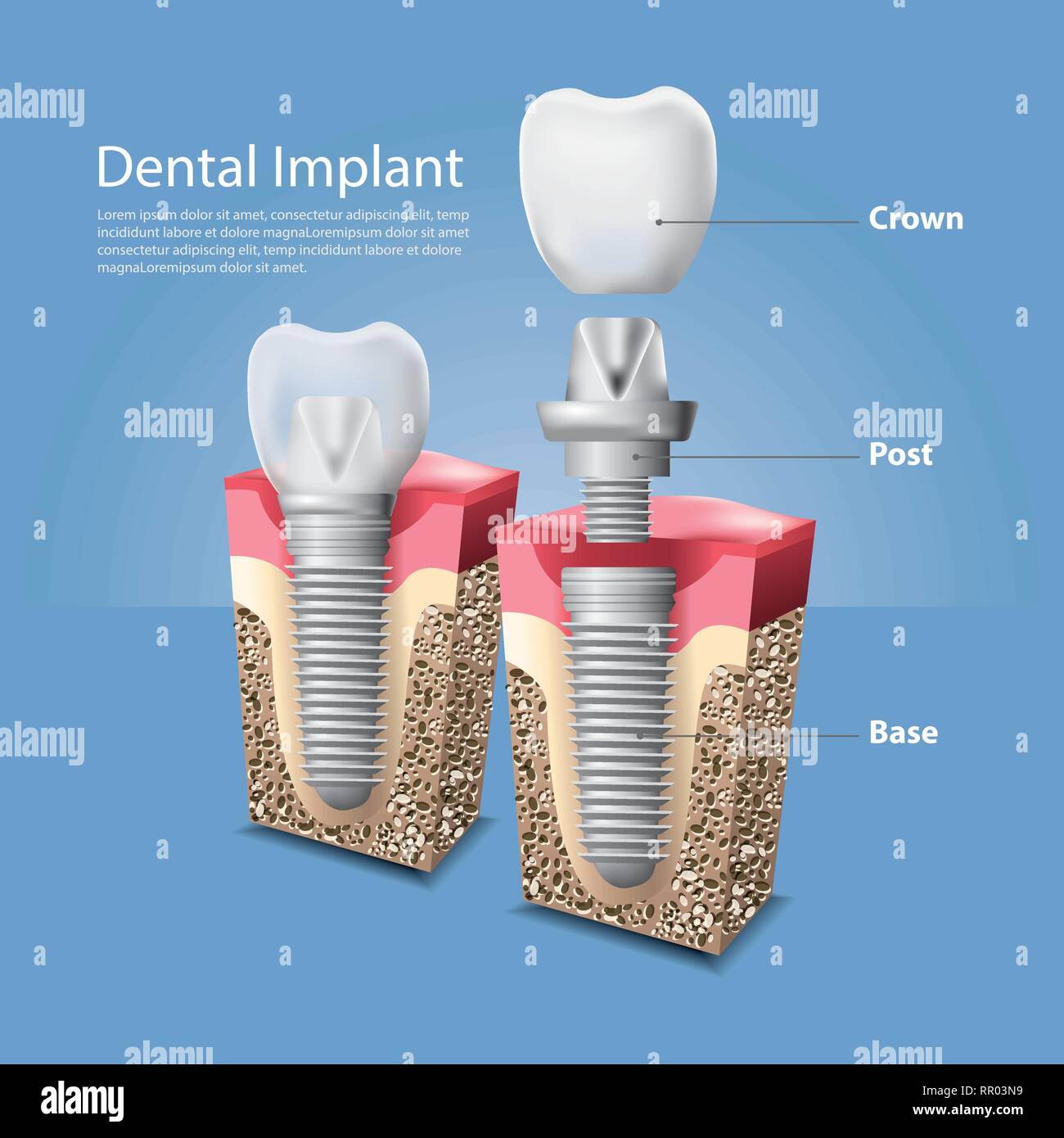 Implanted vector vectors hi-res stock photography and images - Alamy