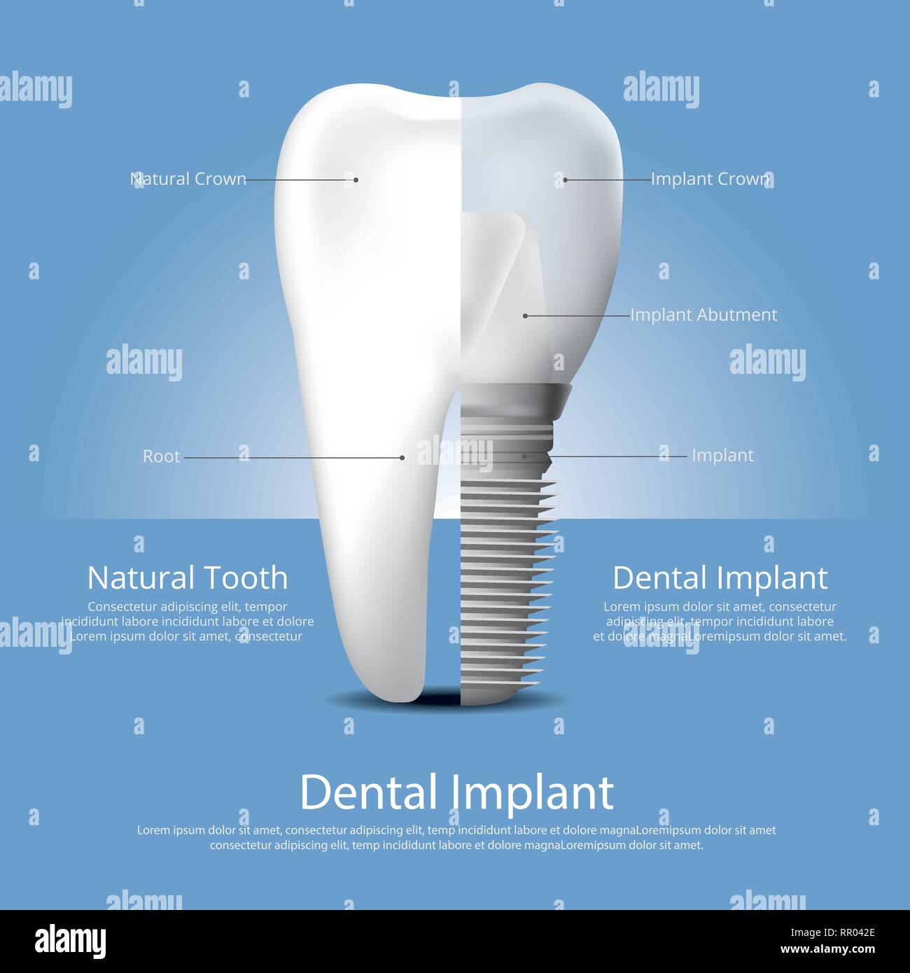 Human teeth and Dental implant Vector Illustration Stock Vector Image ...