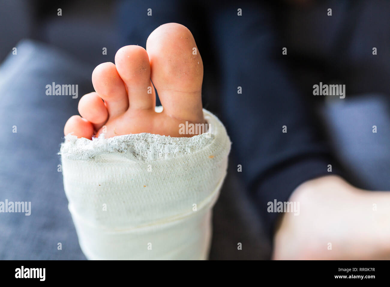 Broken leg in a cast during treatment Stock Photo - Alamy