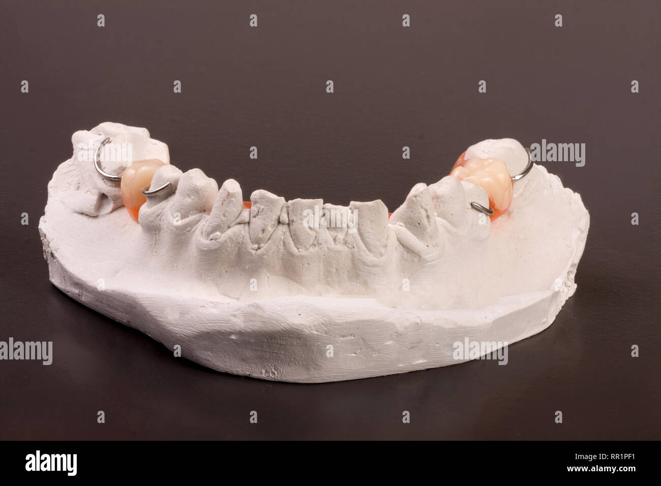 plaster cast of teeth with removable partial denture on a dark ...