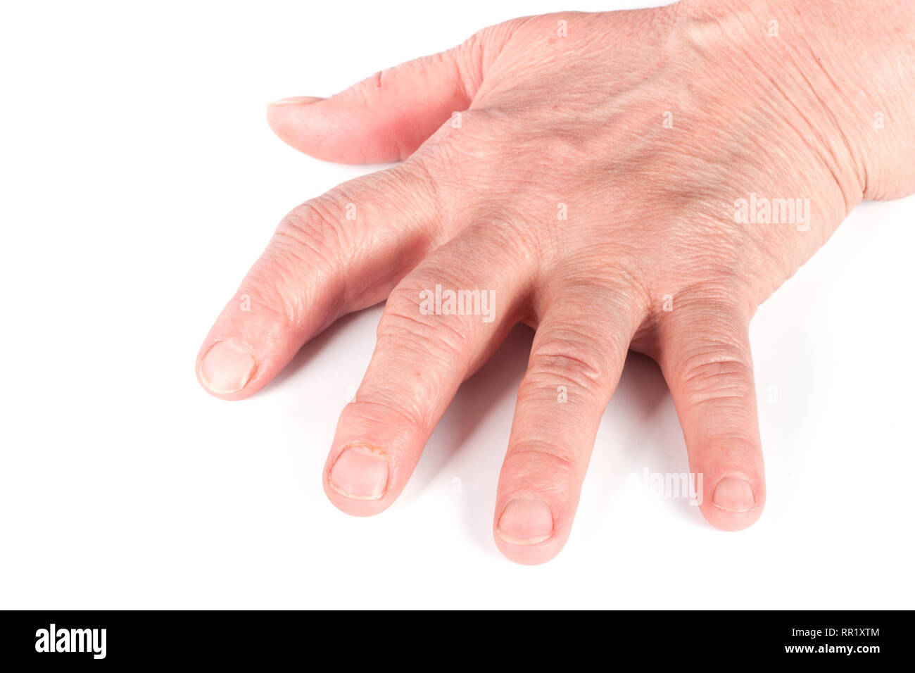 Rheumatoid arthritis hands hi-res stock photography and images - Alamy