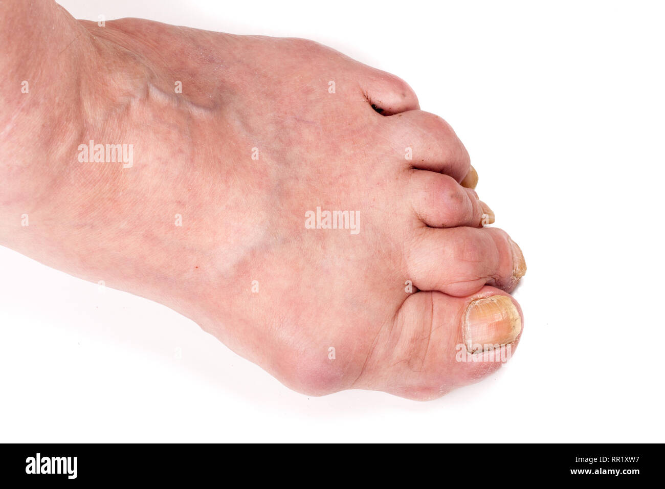 Hyperemia hi-res stock photography and images - Alamy
