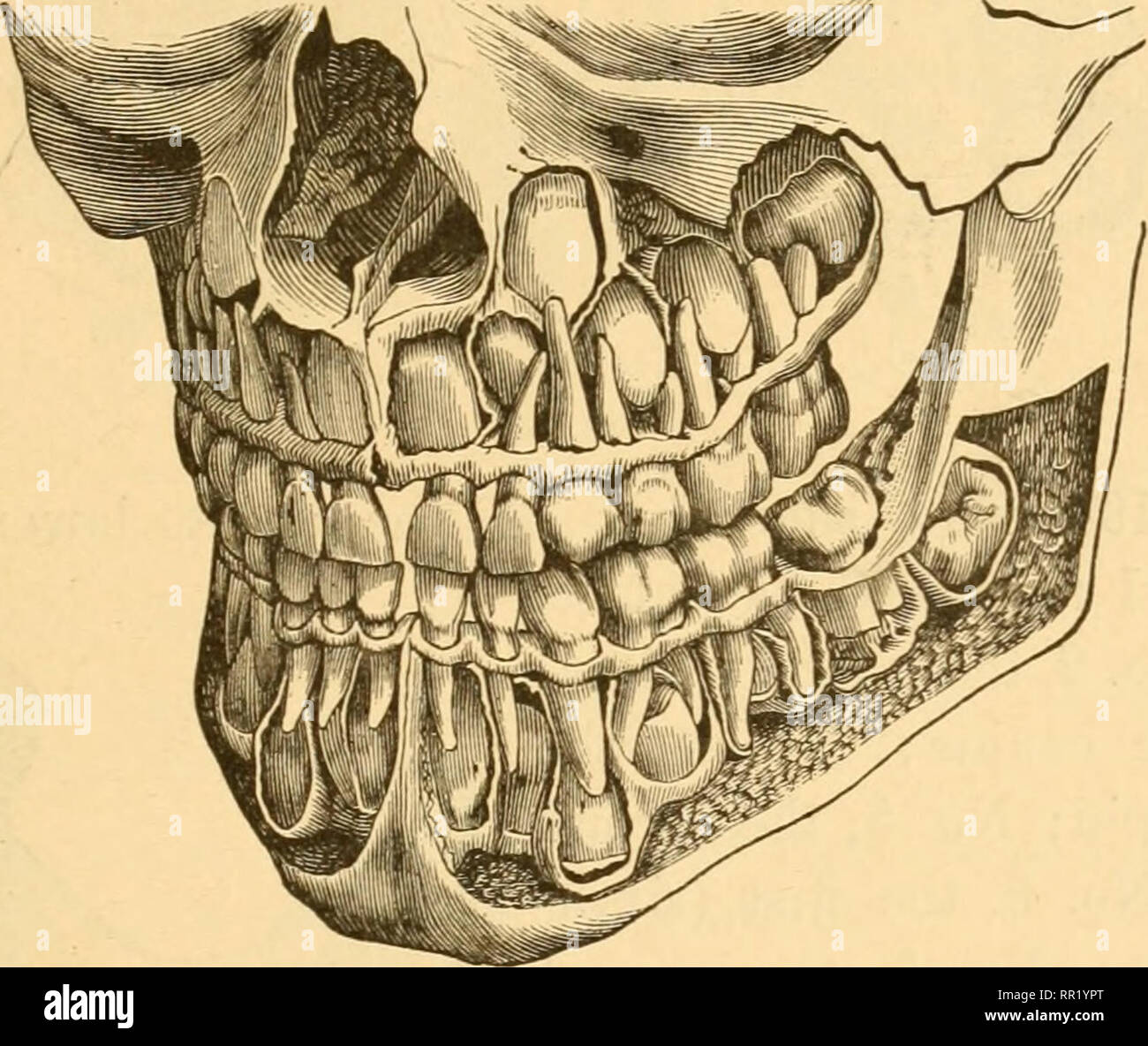 Molars erupting hi-res stock photography and images - Alamy