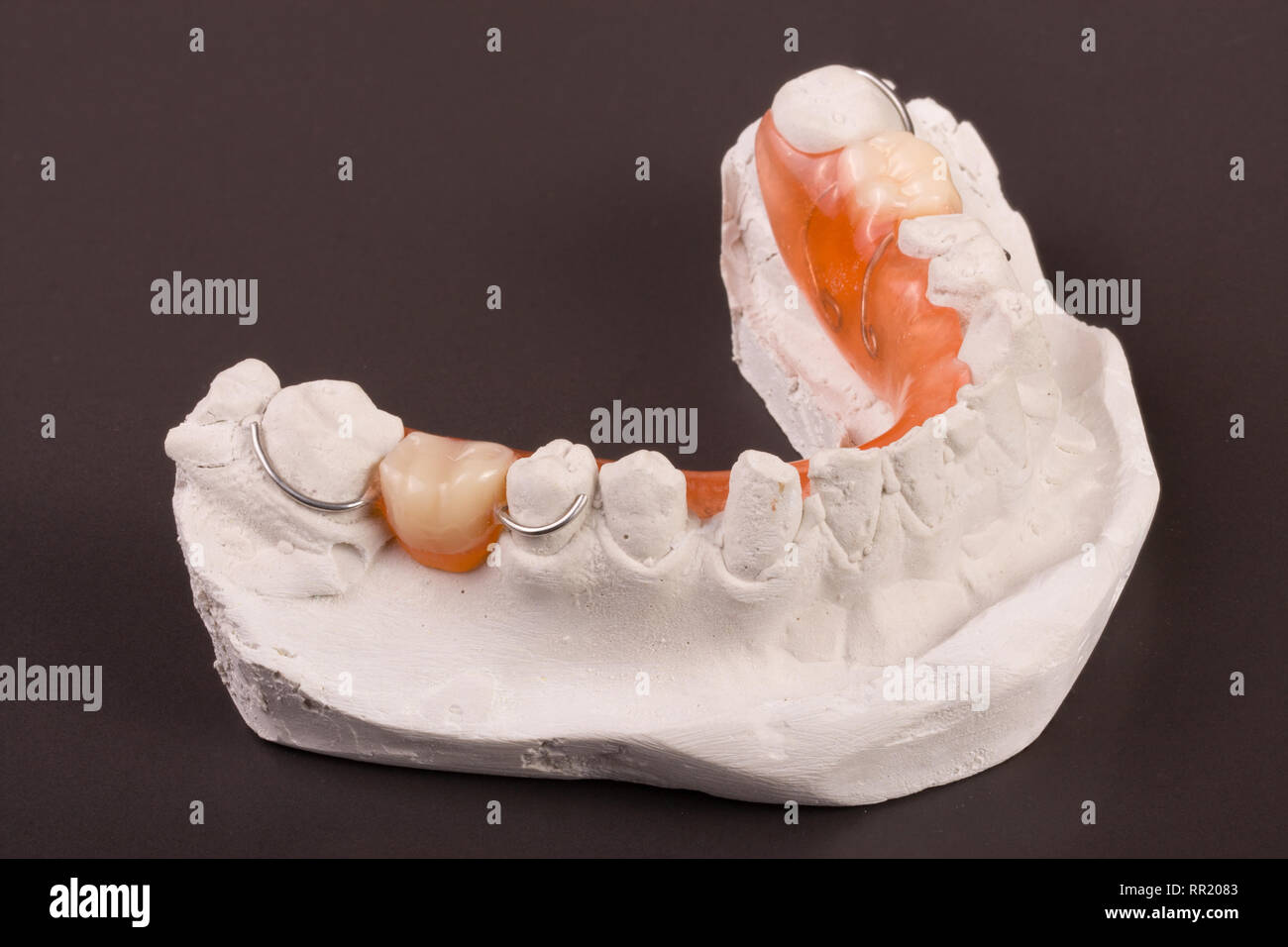 plaster cast of teeth with removable partial denture on a dark ...