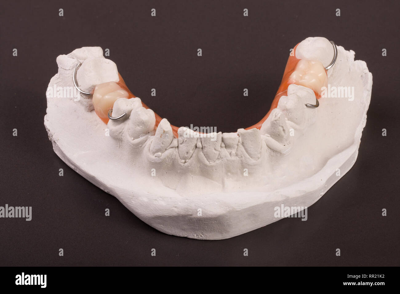 plaster cast of teeth with removable partial denture on a dark ...