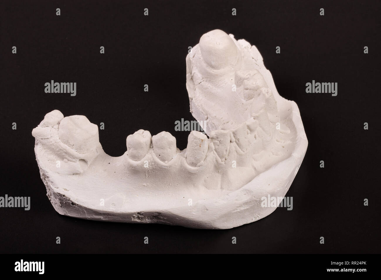 Removable partial denture lower teeth hi-res stock photography and ...