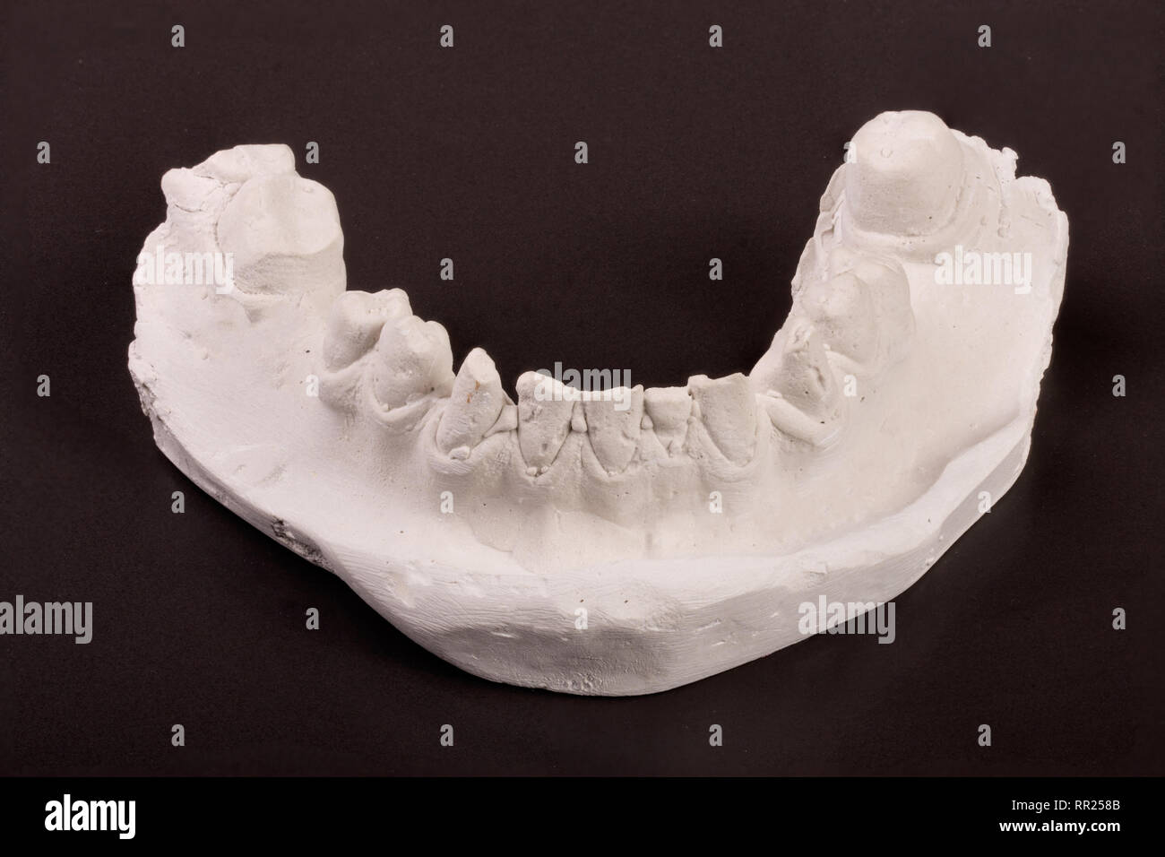 plaster cast of teeth with removable partial denture on a dark ...