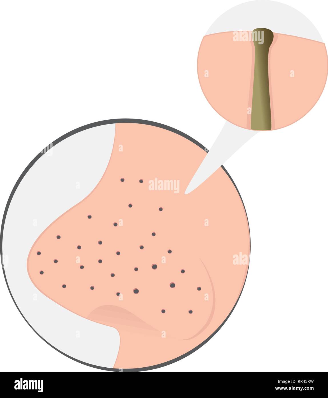 Blackheads on Nose treatment before and after vector illustration showing skin problems Stock ...