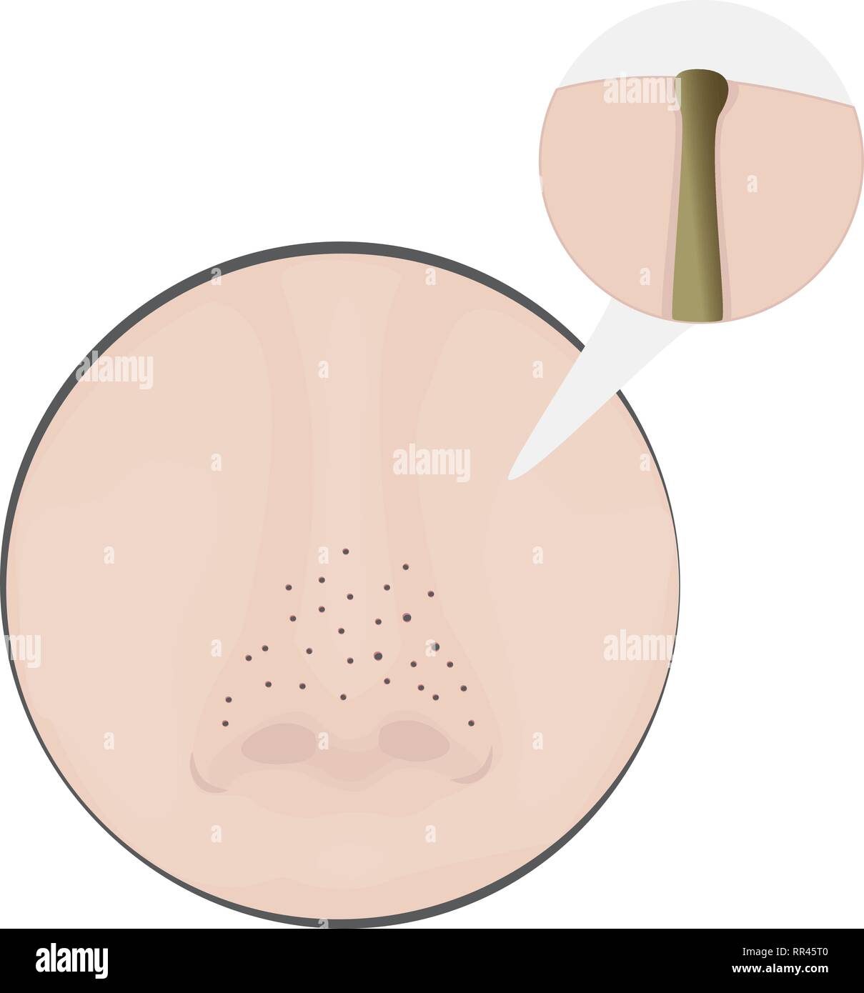 Blackheads on Nose treatment before and after vector illustration showing skin problems Stock ...