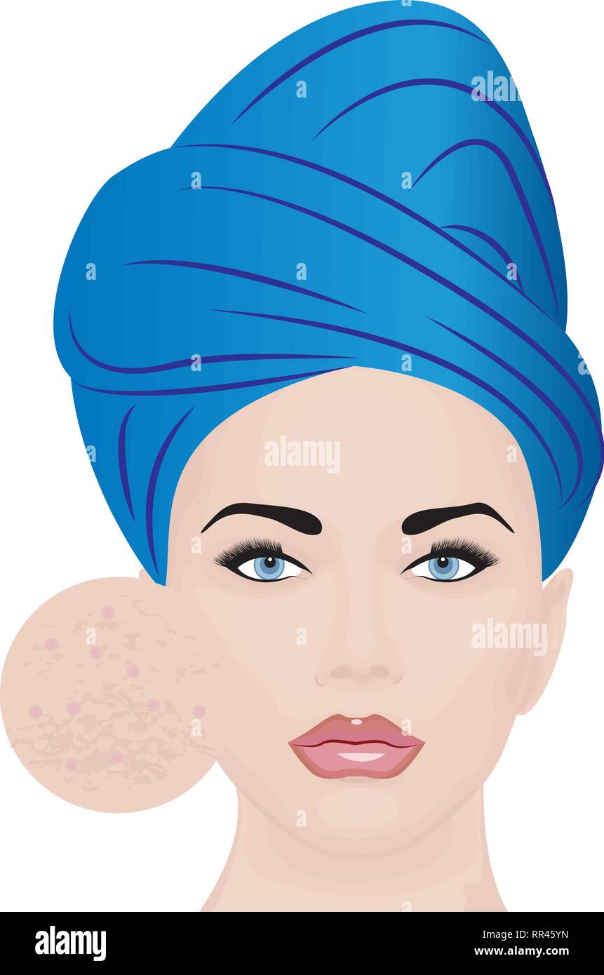 Vector illustration of a girl having skin problems Stock Vector Image ...