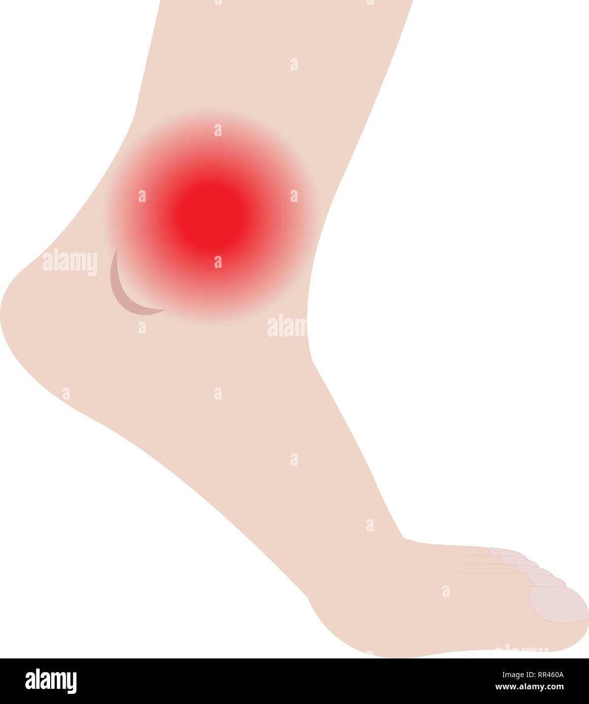 Blister Skin Stock Vector Images - Alamy