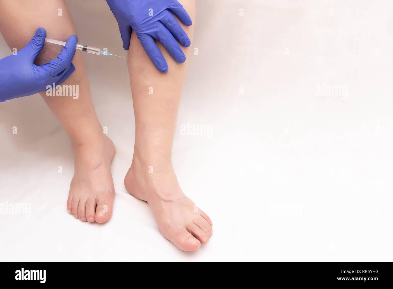 The doctor makes an injection of sclerotherapy to the patient who has ...