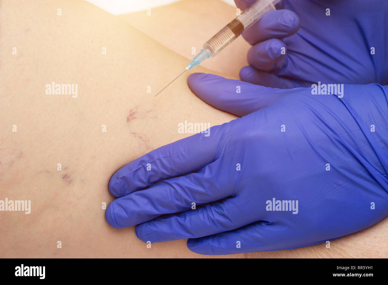 The doctor makes an injection of sclerotherapy in varicose veins ...
