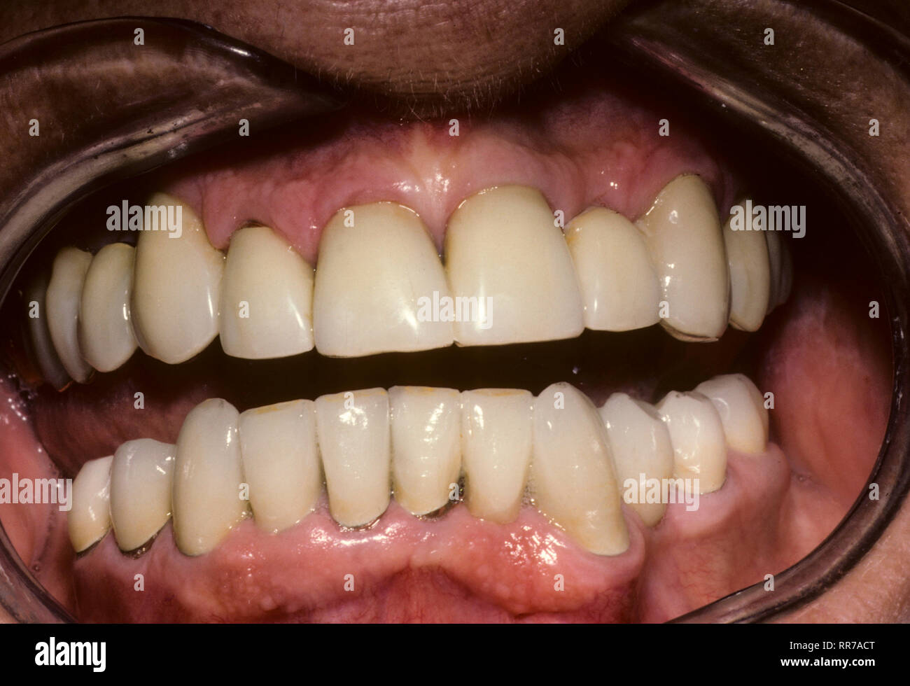 Mouth with newly inserted teeth through implant s Stock Photo - Alamy