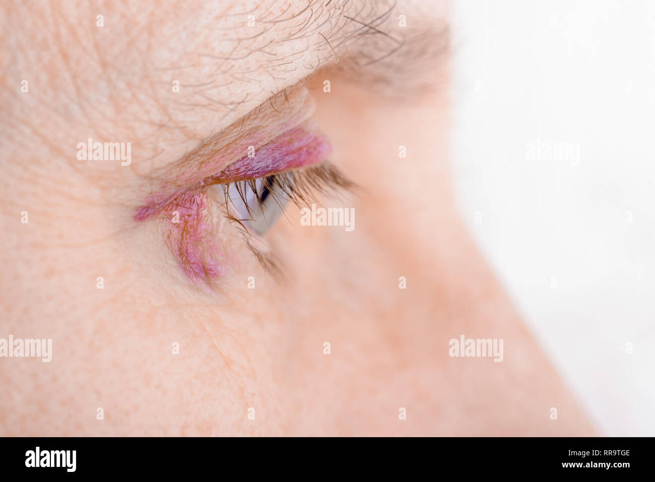 Woman's eye injured due to rupture of capillary, causing hematoma or ...