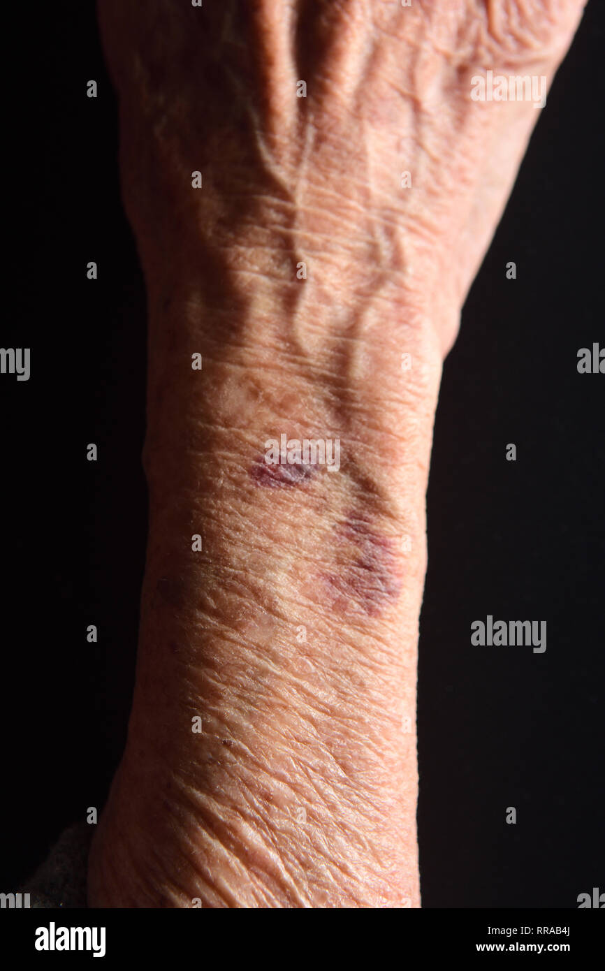 Hematoma arm hi-res stock photography and images - Alamy