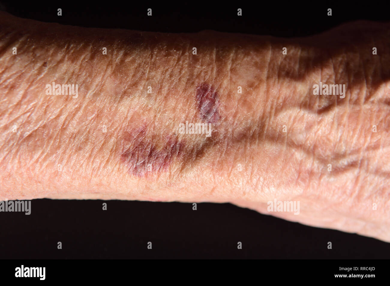 Skin bruise texture hi-res stock photography and images - Alamy