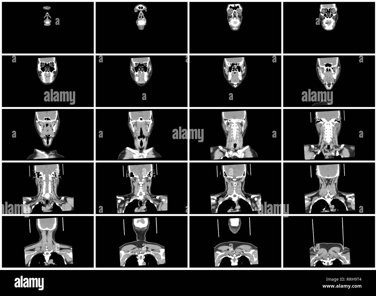 ct scan step set of neck coronal view Stock Photo - Alamy