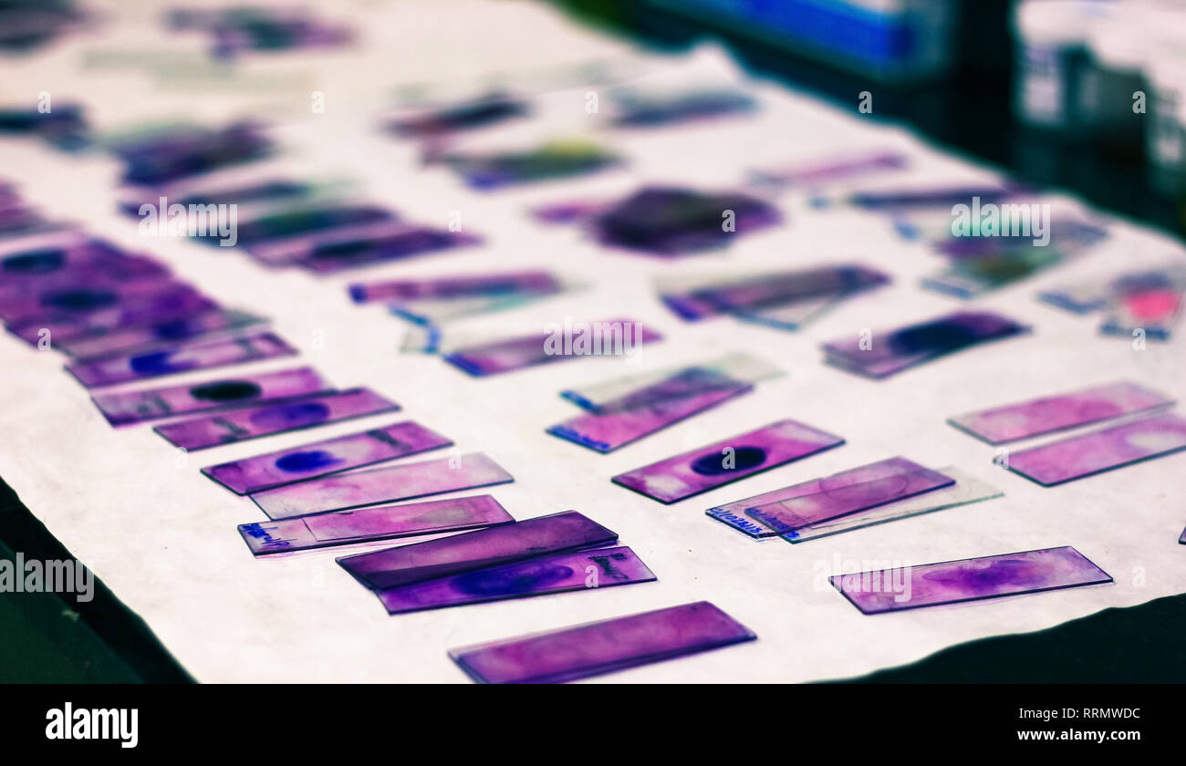 Blood smear glass hi-res stock photography and images - Alamy