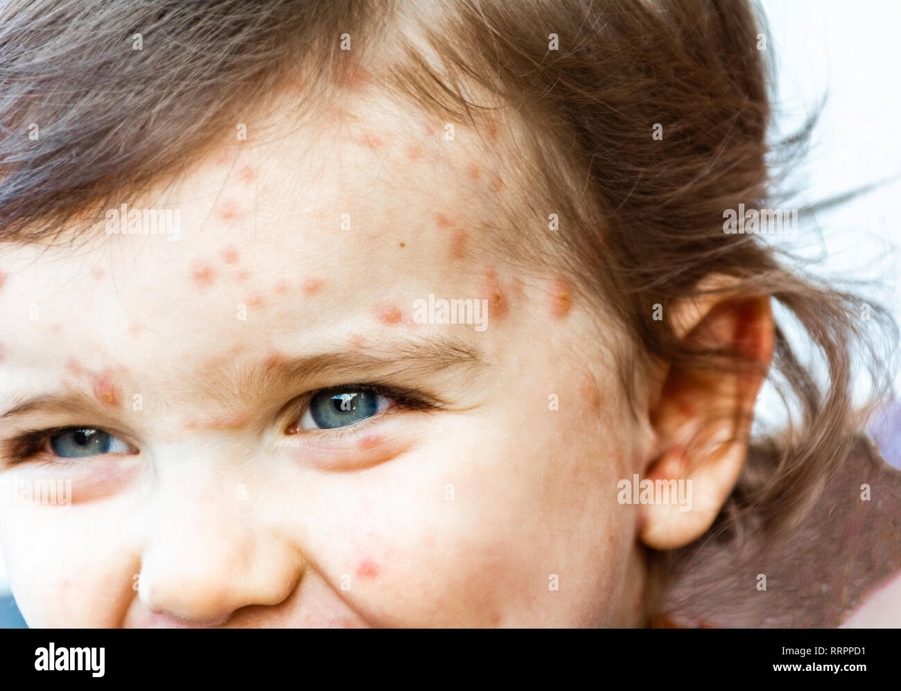 Close up shot of varicella virus or chicken pox bubble rash and blister ...