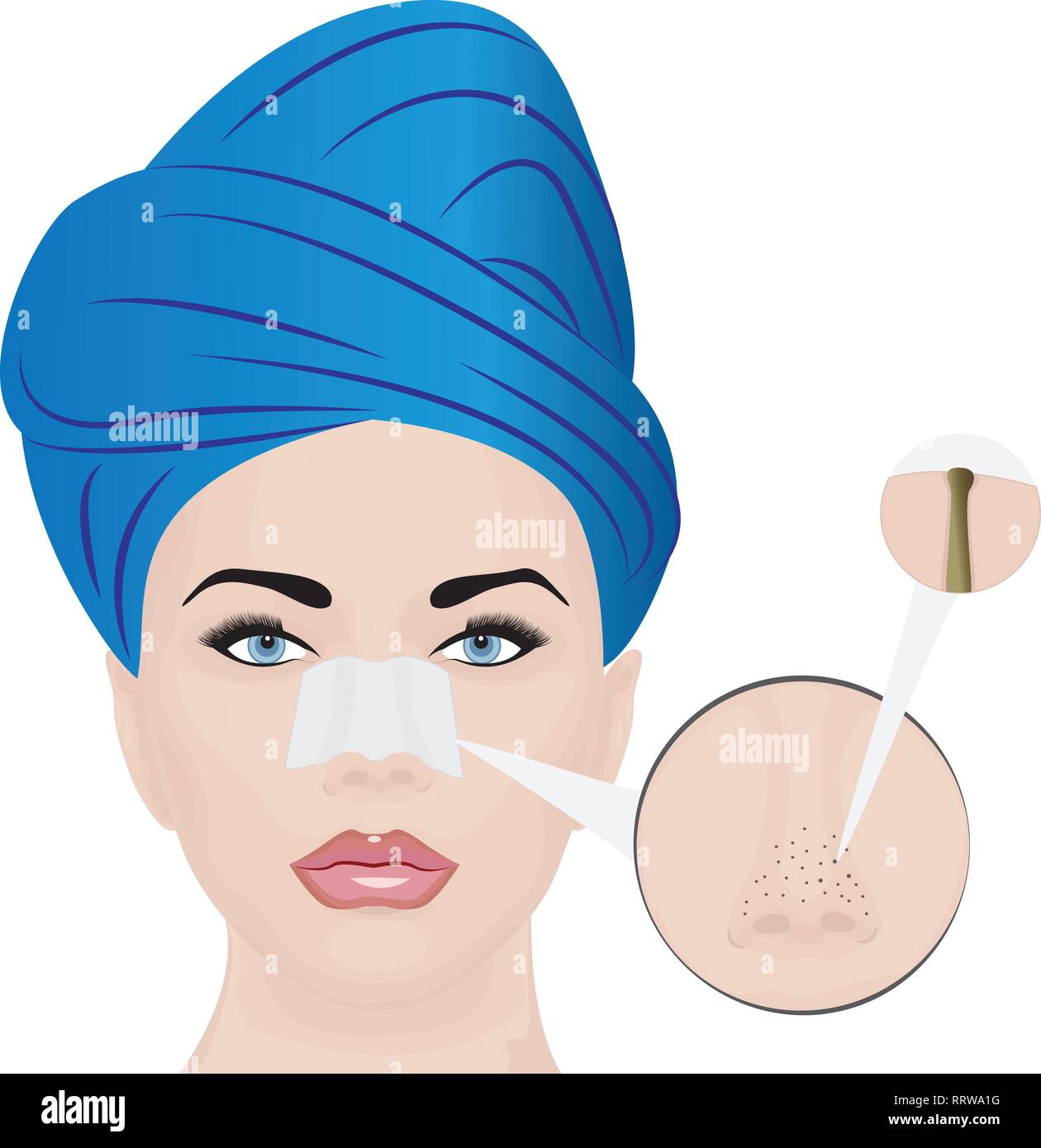 Treatment Blackheads on Nose vector illustration showing skin problems ...