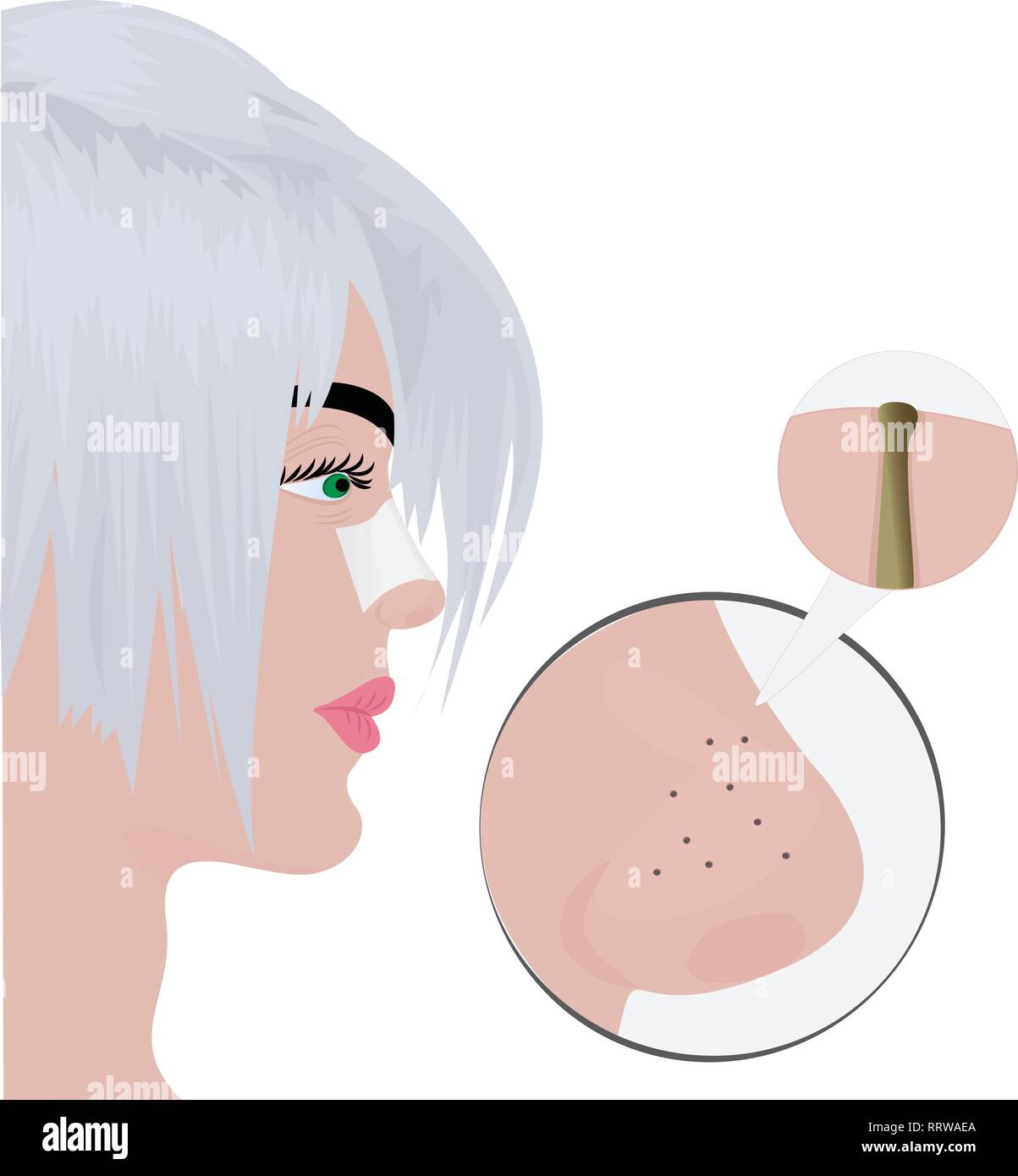 Treatment Blackheads on Nose vector illustration showing skin problems ...