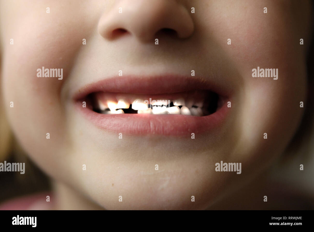 Little kid lost teeth empty space lips mouth space Stock Photo - Alamy