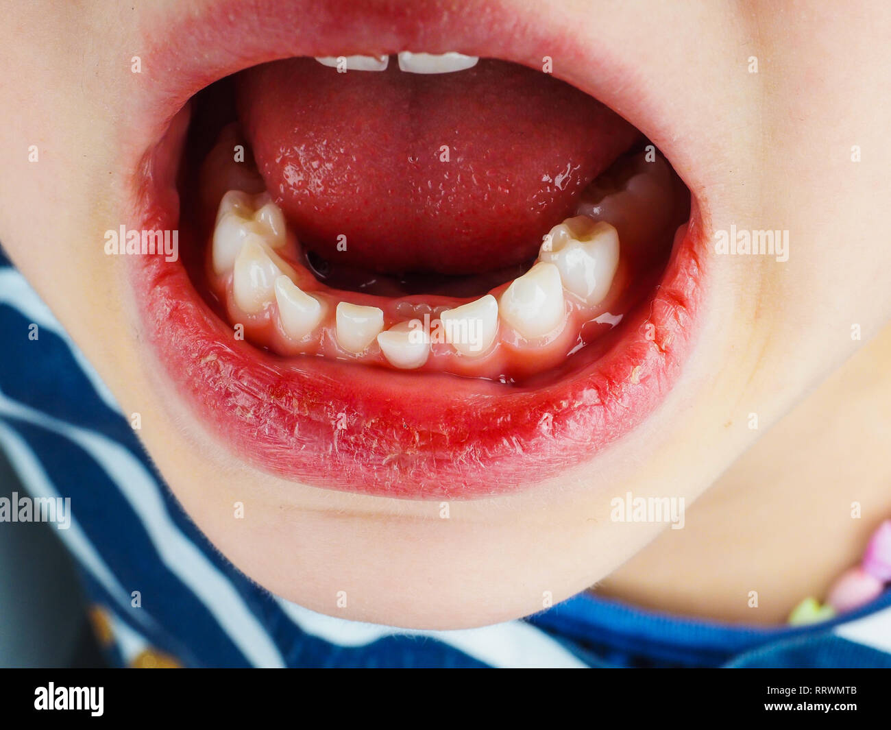 Deciduous Teeth High Resolution Stock Photography and Images - Alamy
