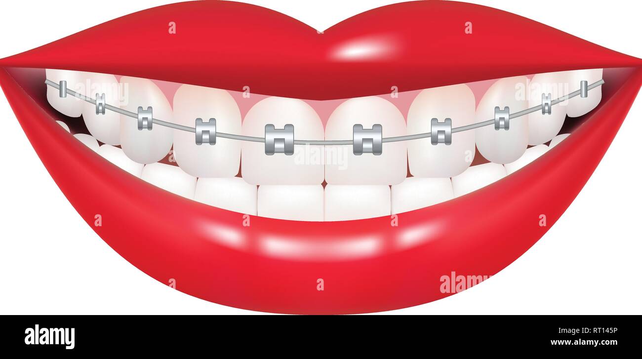 Dentist, orthodontist. Vector illustration. Braces on teeth. Open mouth ...