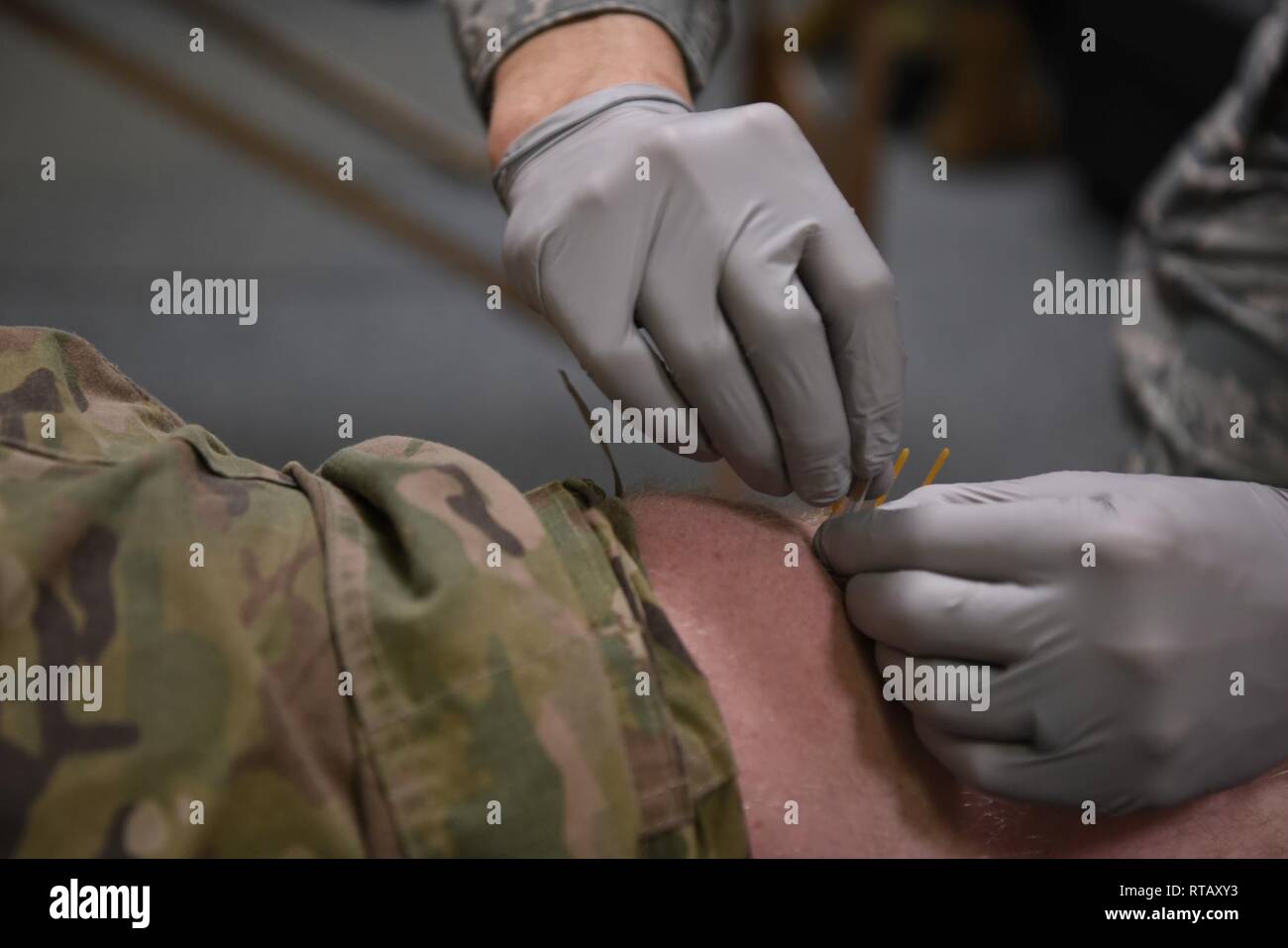 Battlefield acupuncture hi-res stock photography and images - Alamy