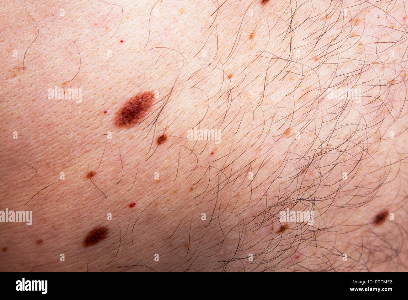Benign nevus skin dermatology hi-res stock photography and images - Alamy