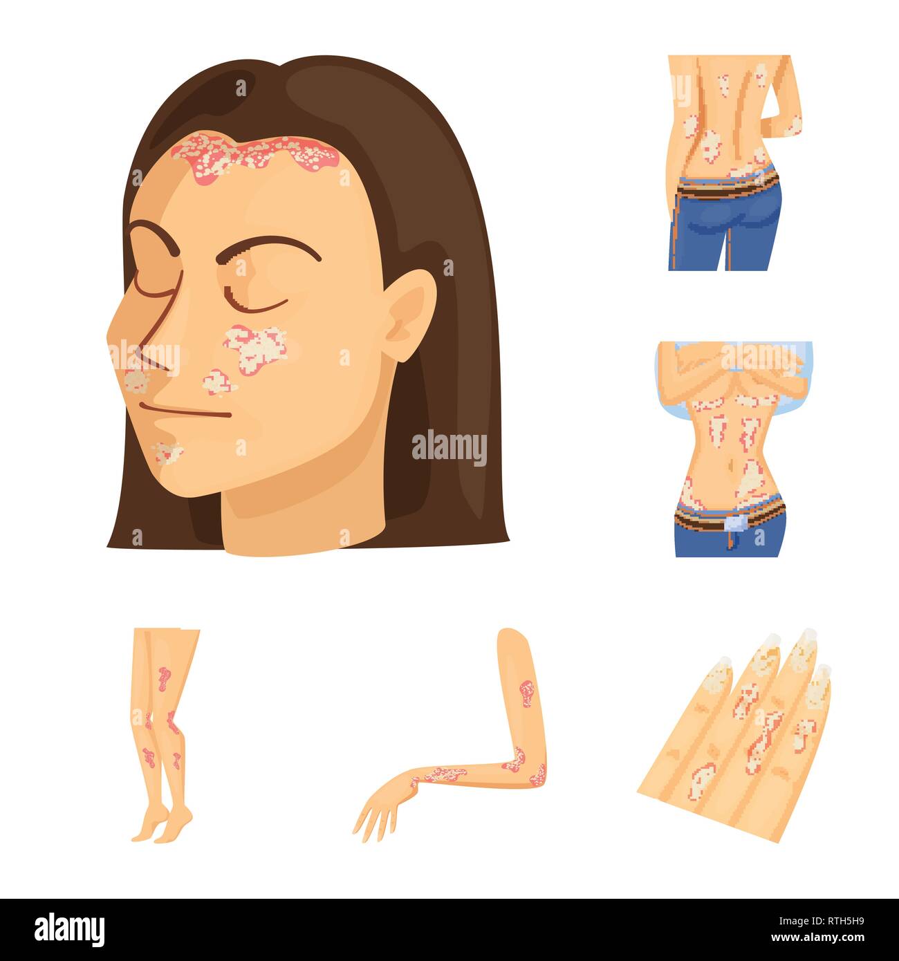 psoriasis,skin,body,dermatitis,chronic,allergy,eczema,itch,rash,stress ...