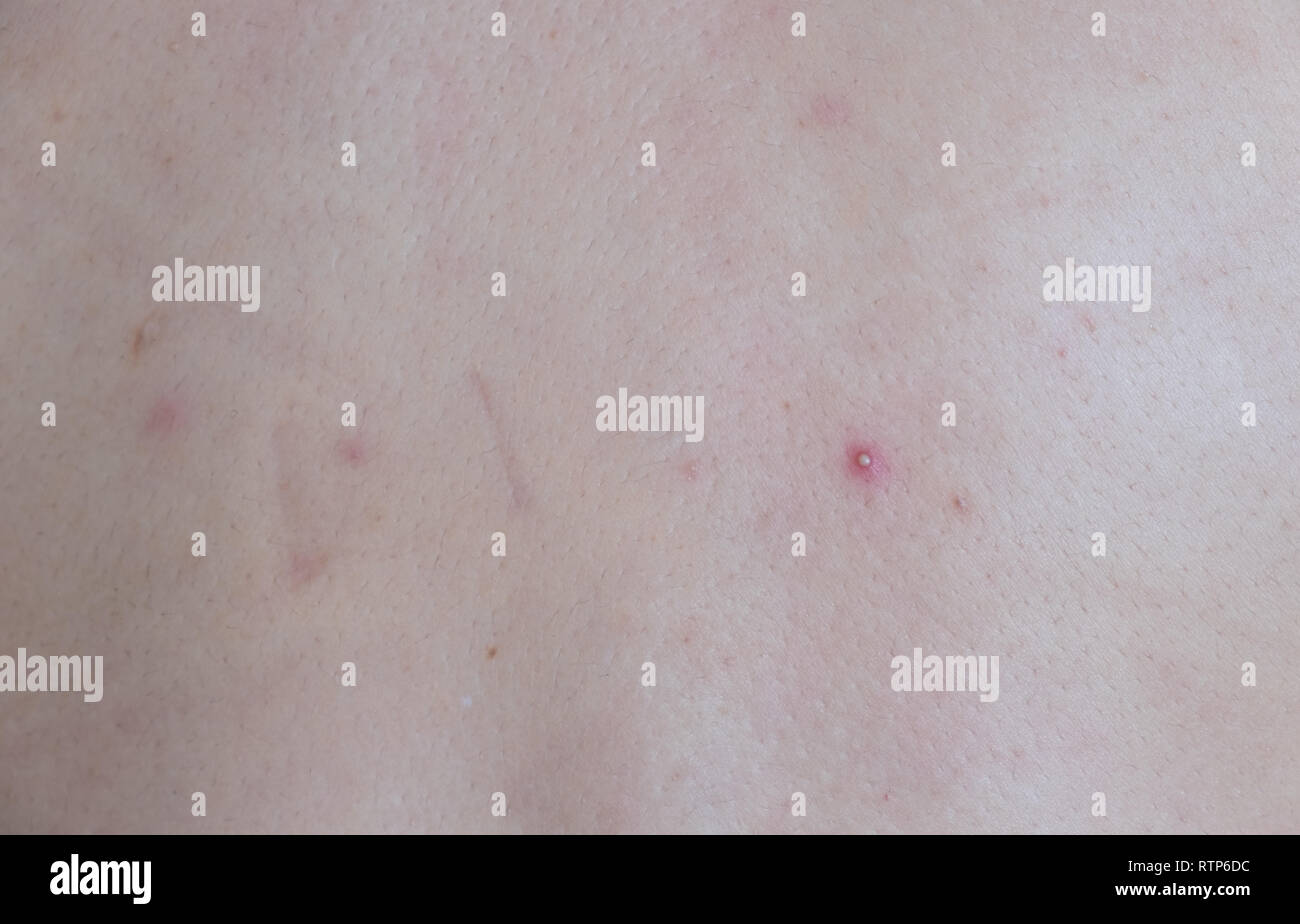 Acne, dermatitis. Acne On The Back Stock Photo - Alamy