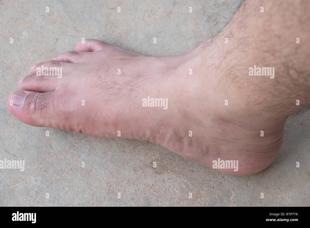 Lap Feet Or Flat Foot. Health & Foot Care, Closeup cracked heels and ...